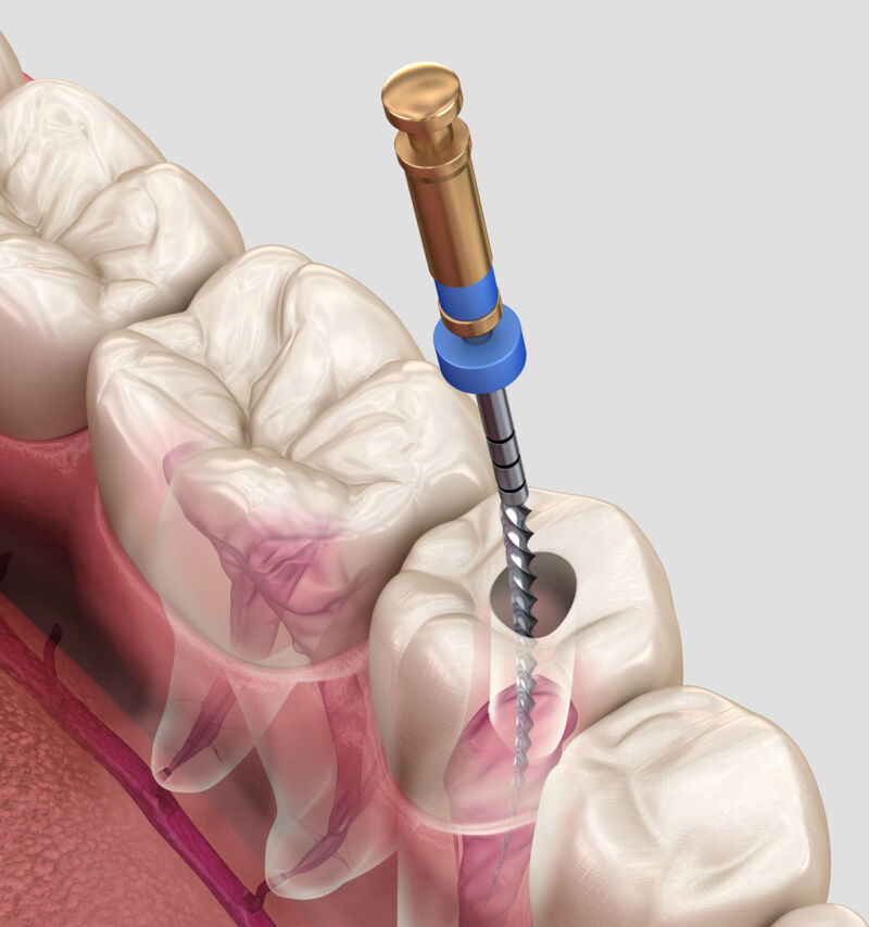 Dental Trauma Calgary Complete and Partial Dentures Calgary | Chinook ...