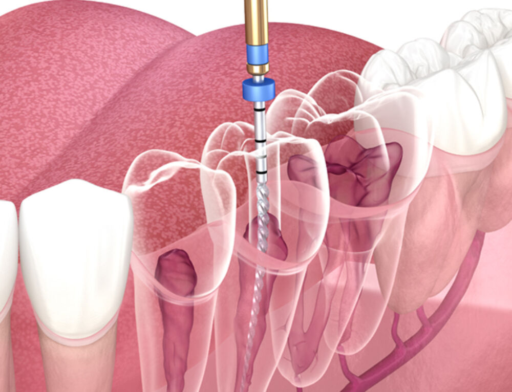 What is a Root Canal? | Chinook Dental Group