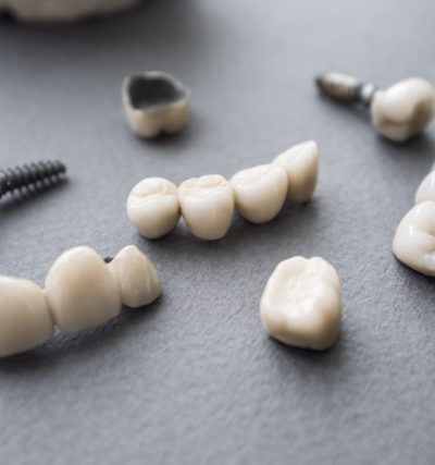 Teeth In A Day: All-On-Four Dental Implants | Chinook Dental Group