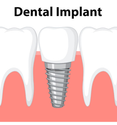 Calgary Dental Specialties: Endo, Perio, Prostho | Chinook Dental Group