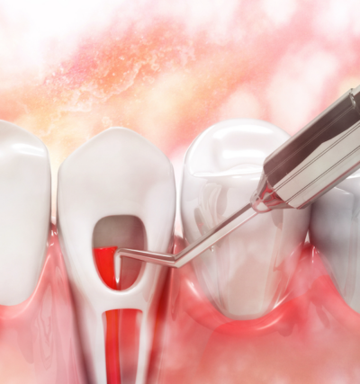 Calgary Dental Specialties: Endo, Perio, Prostho | Chinook Dental Group