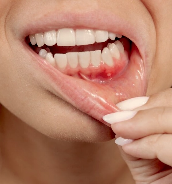 Cancer White Spots On Gums Pictures In Korea Infoupdate Cancer White Spots On Gums Pictures In Korea Infoupdate
